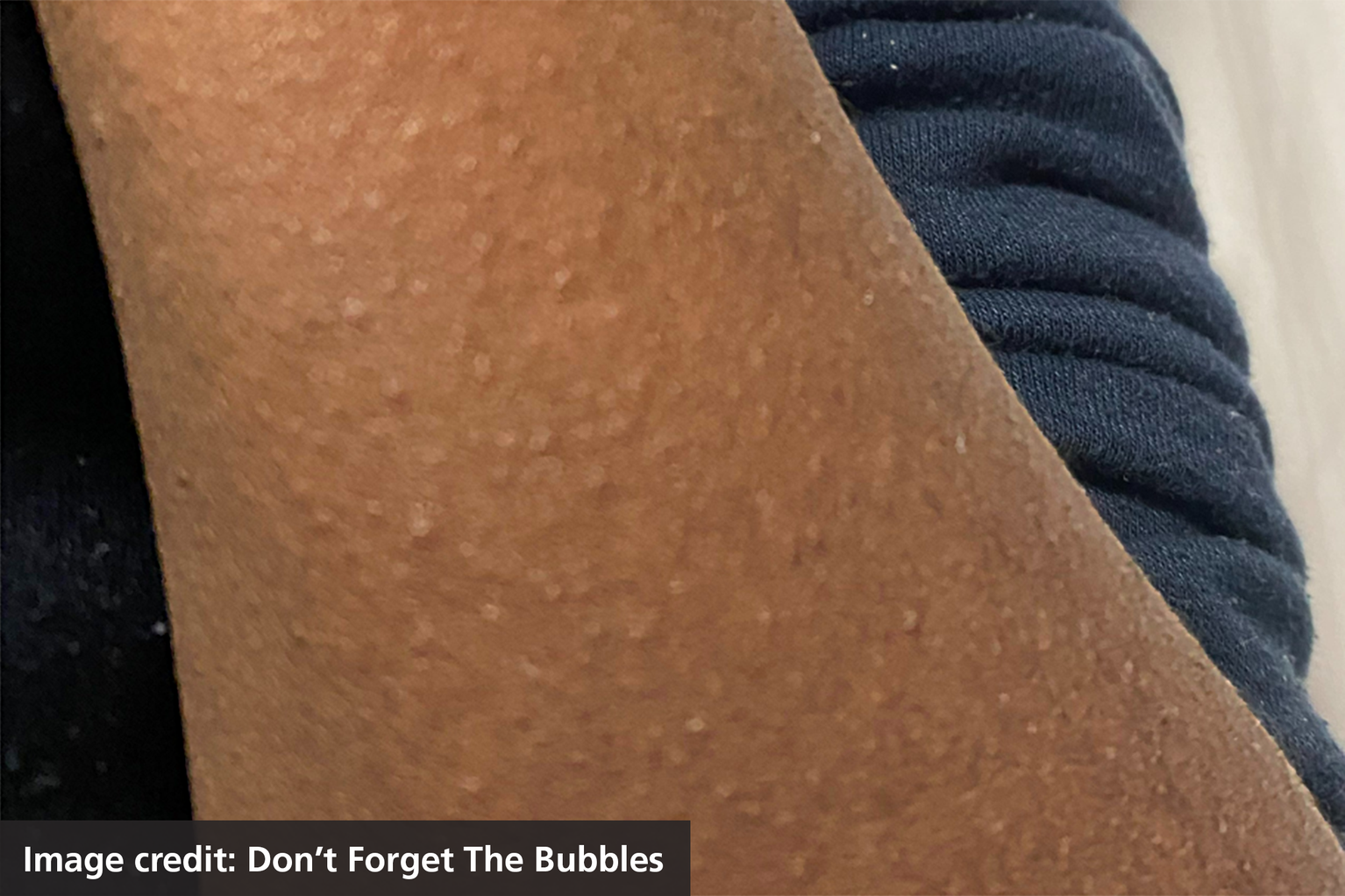 Group A Strep and Scarlet Fever - Alder Hey Children's Hospital Trust