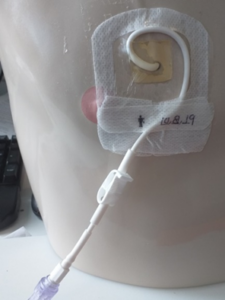 My child needs a Broviac/Hickman Line - Alder Hey Children's Hospital Trust