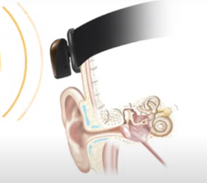 Bone conduction hearing devices (BCHDs) - Alder Hey Children's Hospital ...